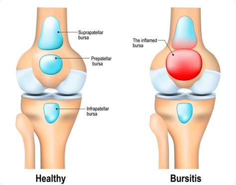 Bursitis And Osteoarthritis Similarities And Differences