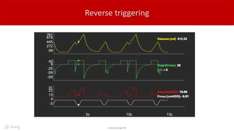 Assincronia Paciente Ventilador Mecânico