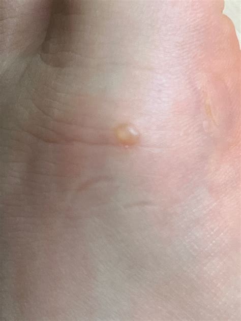 발에 투명한 물집이 났는데 왜 나는거에요 지식in