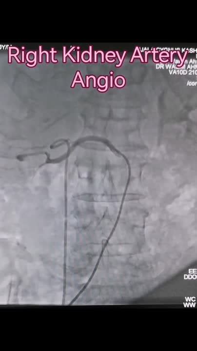 Coil Embolisation Of Renal Avm With Persistent Bleeding Haematuria