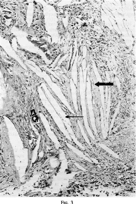 Figure 1 From Cholesterol Granuloma Of The Paranasal Sinuses Semantic
