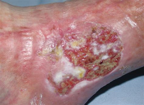 Wound Guide Epithelialising Advancis Medical