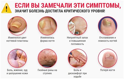 Мазь Micolock Миколок от грибка ногтей инструкция по применению реальные отзывы купить в