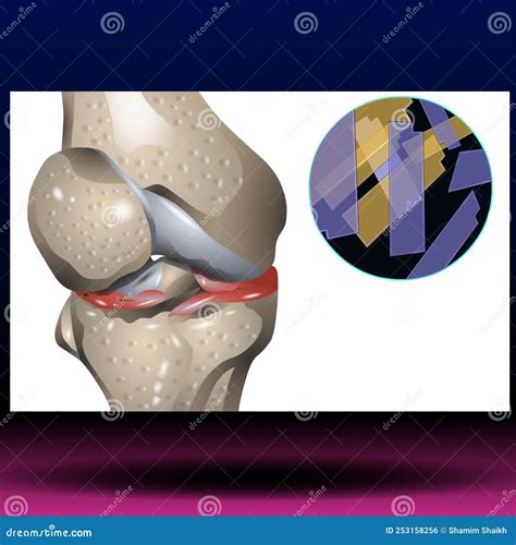 Hueso De Rodilla Con Cristales Cpp Stock De Ilustración Ilustración De Completo