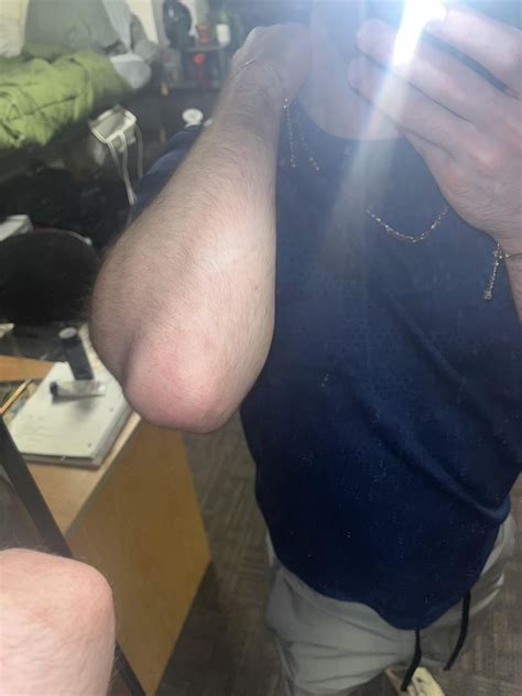 Do I Have Ringworm On My Elbow R Dermatologyquestions