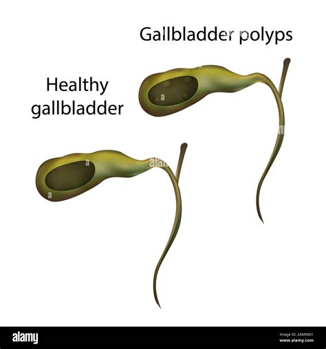 Gallbladder Polyps Symptoms Causes What It Is 43 Off