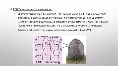Myocardial Infarction Introduction Clinical Manifestation
