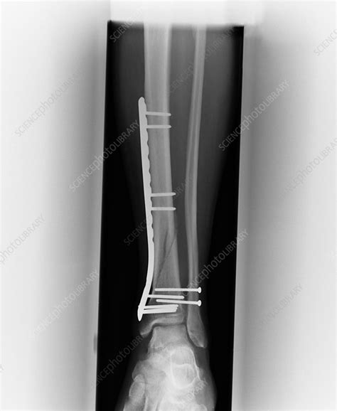 X Ray Of Fractured Tibia And Fibula Stock Image C021 3384 Science Photo Library