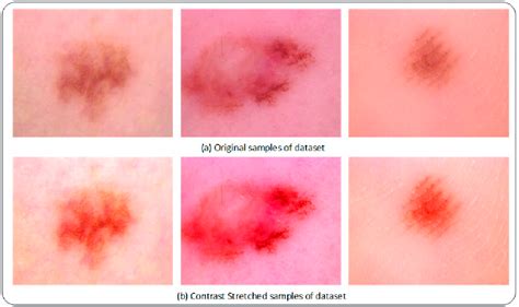 Table 1 From Classification Of Skin Cancer Lesions Using Explainable Deep Learning Semantic
