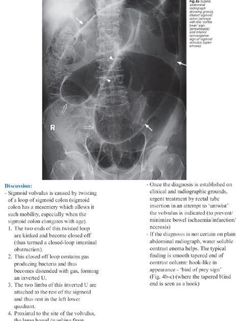 000 Volvulus Sigmoid Pdf