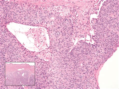 Rapidly Growing Scalp Nodule Mdedge Dermatology