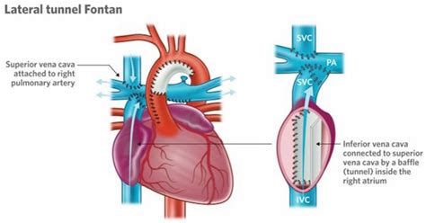 Fontan Procedure Uses Types Recovery And Complications