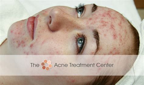 Beforeafter Patient Photos Hyperpigmentation Inflamed Acne The