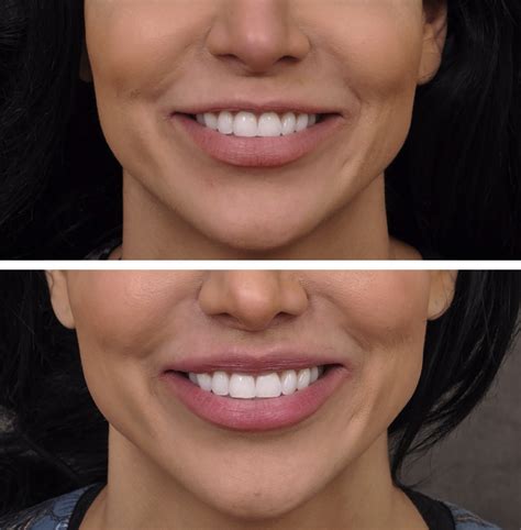 The Modified Upper Lip Lift Facial Plastic Surgery Clinics