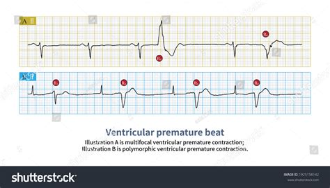 When Coupling Interval Ventricular Premature Contraction Stock Illustration 1925158142