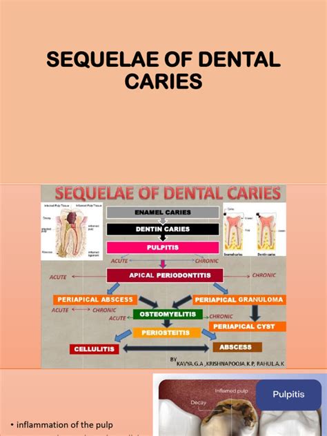 Sequelae Of Dental Caries Pdf Inflammation Necrosis