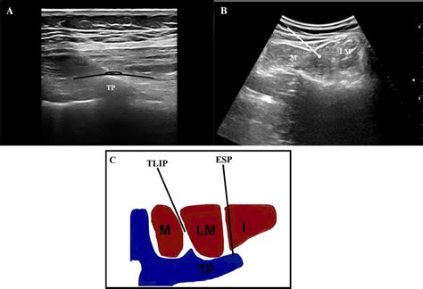 A Ultrasound Image Of Erector Spinae Plane Esp Block B Ultrasound