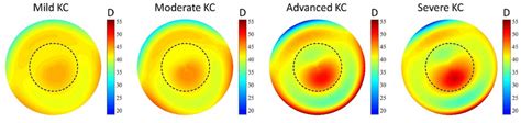 Tangential Curvature Maps Of The Selected Keratoconus Eye Models