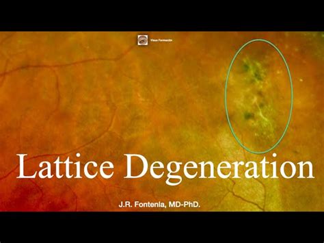 Lattice Degeneration
