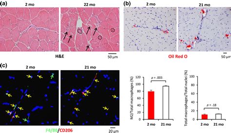 Increased Intermuscular Adipose Tissue Imat And M2 Macrophages In