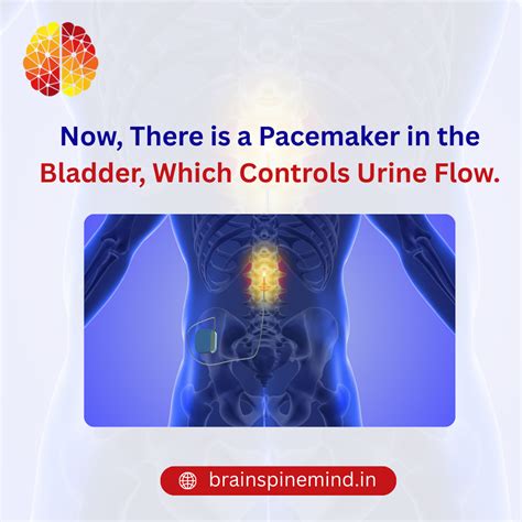 Bladder Pacemaker Treatment By Dr Vaibhav Mathur Urine Flow Control
