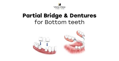 Bridge Lower Partial Dentures Bottom Front Teeth Vitrin