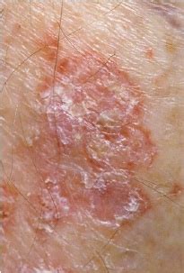 Bowens Disease