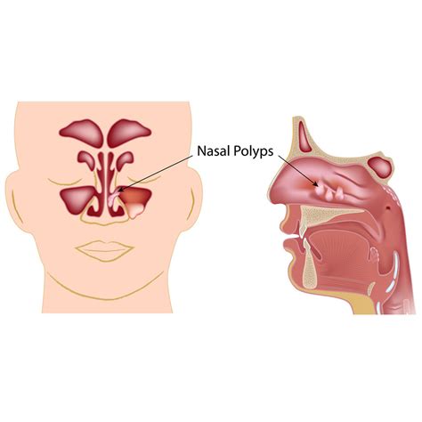 Nasal Polyps Vejthani International Hospital Jci Accredited