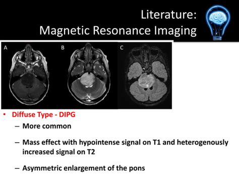 Pediatric Diffuse Intrinsic Pons Glioma Ppt