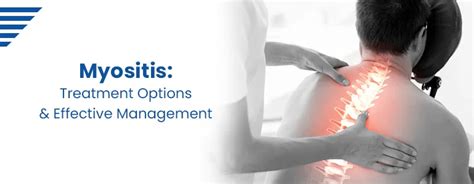 Myositis Treatment Options And Effective Management Sprint Diagnostics