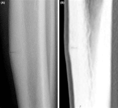 A Transverse “fracture Line” In The Anterior Cortex Of The Tibia On