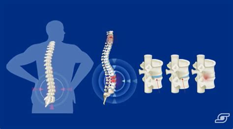 Videoespondiloartritis Ser