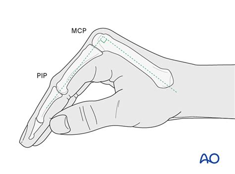 Nonoperative Treatment For Volar Plate Avulsion Of The Proximal End Segment
