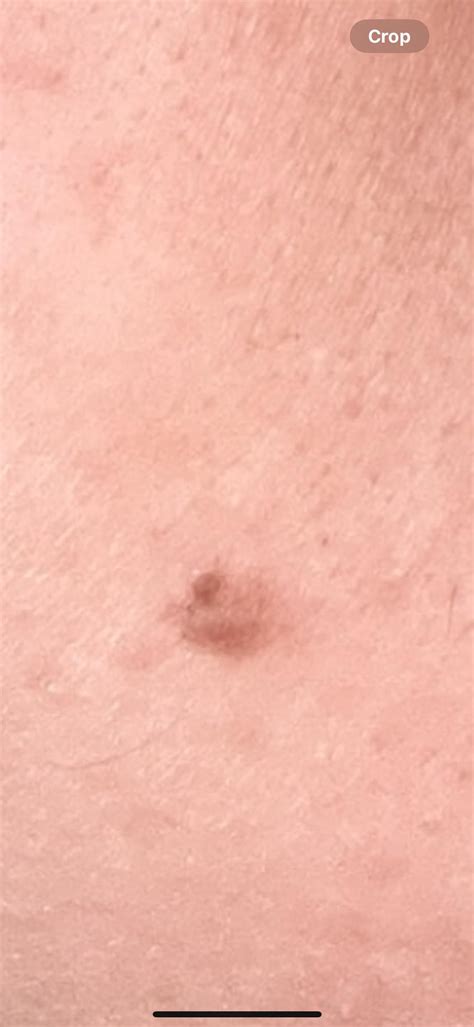 Does This Mole Look Sus R Dermatologyquestions