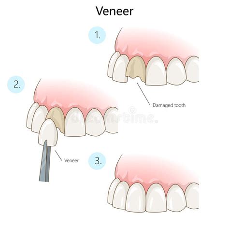 Dental Veneer Application Process Diagram Medical Stock Illustration