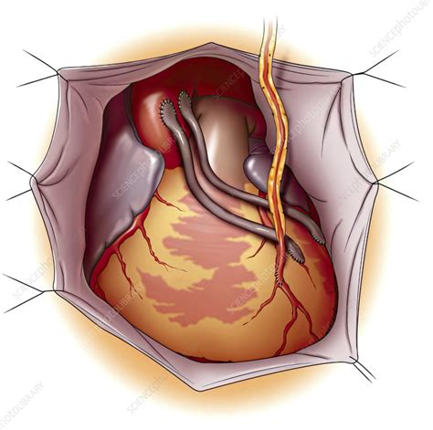 Bypass Surgery Illustration Stock Image C0593260 Science Photo Library