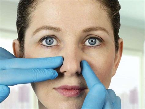 Deviated Septum 10 Deviated Septum Symptoms