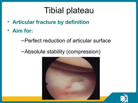 Proximal Tibial Fracture PPT