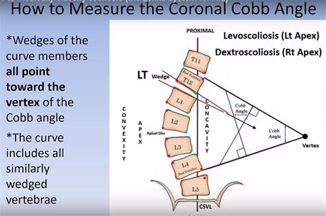 Lenke Classification For Scoliosis —