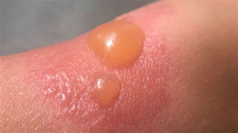 Want To Avoid Blister Try These Home Remedies To Treat Burn Wound