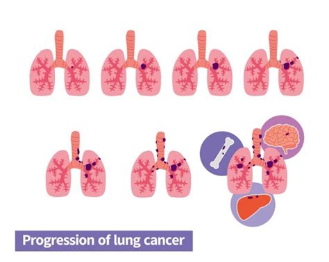 Lung Cancer Stages Nj Ct And Md Regional Cancer Care Associates
