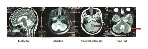 Multiple Cystic Lesions In Cerebellum With Enhancing Neural Nodules And