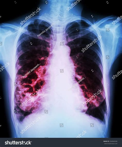Bronchiectasis Xray Chest Show Multiple Lung Foto De Stock 204964540 Shutterstock