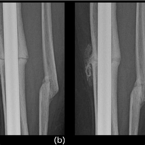 Case 1 Radiograph Series Of Left Tibia Fibula After Osteotomy And Imn Case 1 Radiograph Series Of Left Tibia Fibula After Osteotomy And Imn