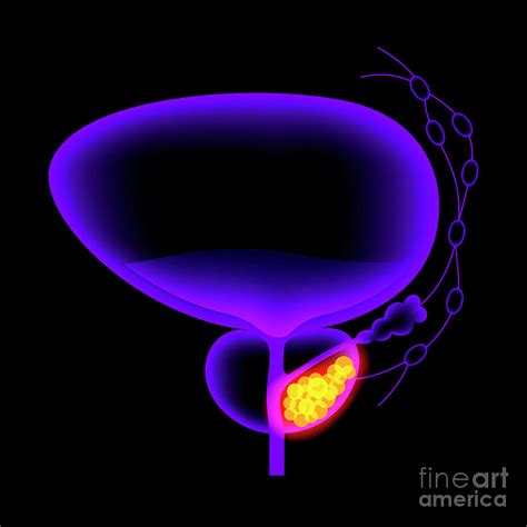 Prostate Cancer Photograph By Pikovit Science Photo Library Fine Art America