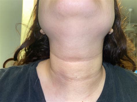 Two Swollen Lymph Nodes R Lymphnodes
