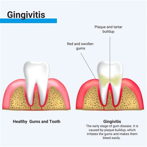Severe Gingivitis
