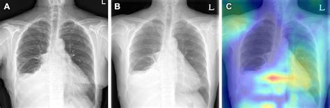 Ai Model Shows Promise For Interpreting Follow Up Chest X Rays Auntminnie