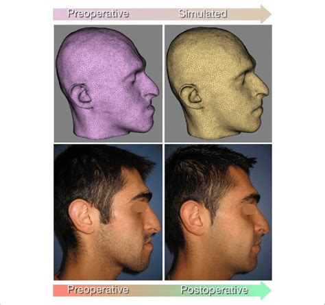 Comparison Between The Preoperative And Simulated Models And Download Scientific Diagram