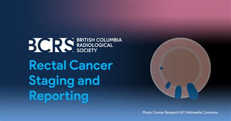 Rectal Cancer Staging And Reporting British Columbia Radiological Society